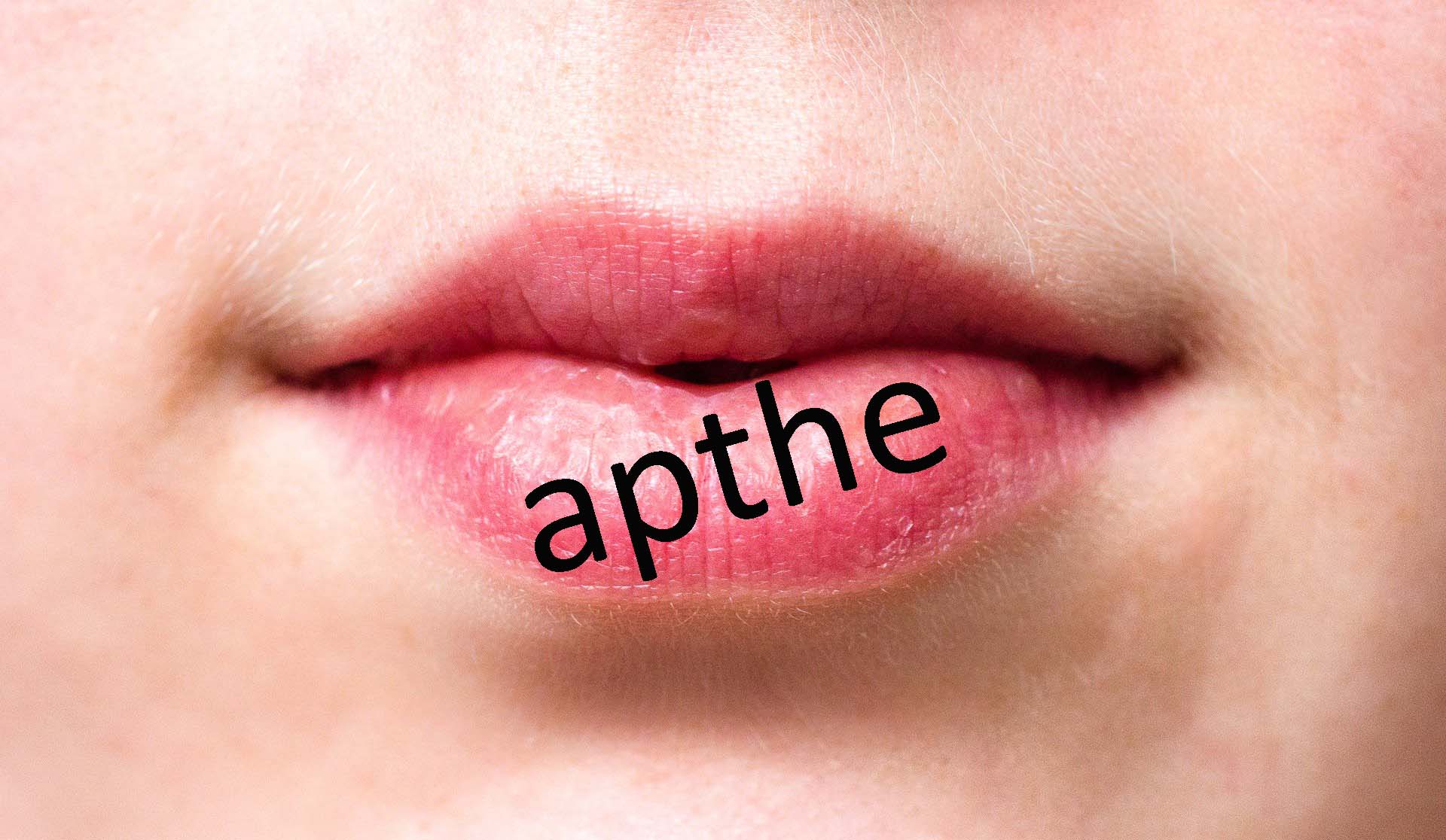 Aphte / Remèdes naturels / Naturopathie / Naturiel